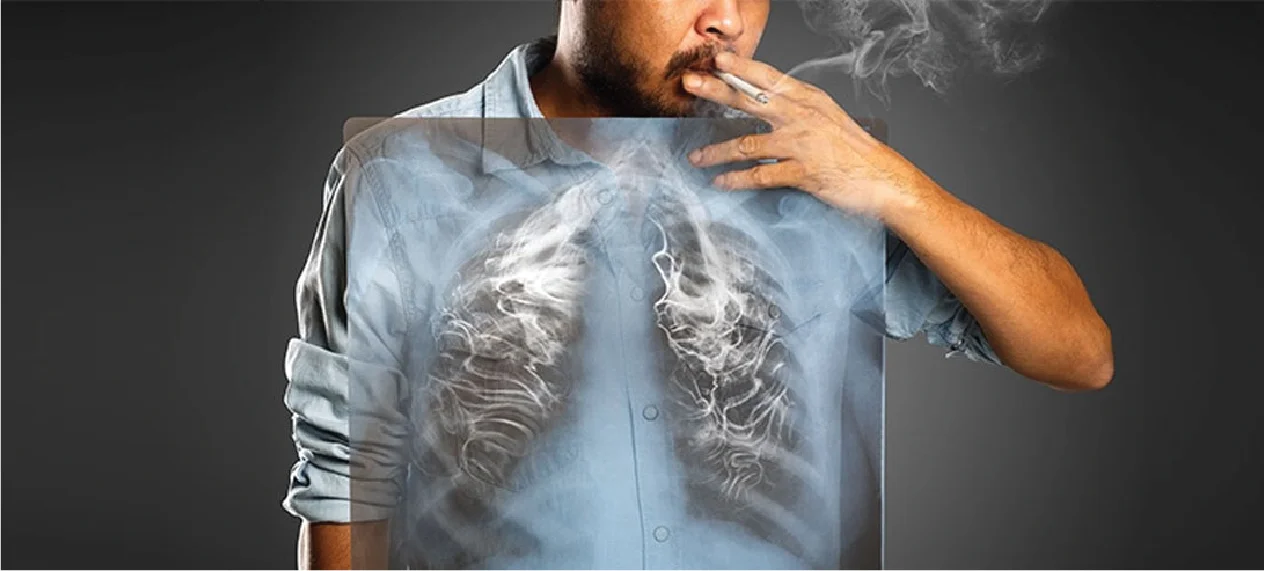 Smoking and Lung Cancer: Health Risks and Treatment Insights - BMCHRC