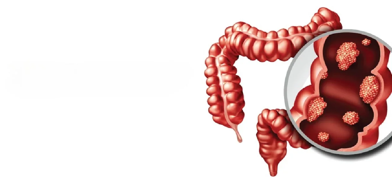 Things to Know About Colon Cancer and Its Types | BMCHRC Udaipur