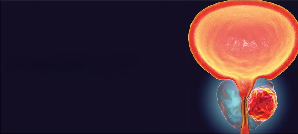 What Are The 5 Warning Signs Of Prostate Cancer? | BMCHRC Hospital