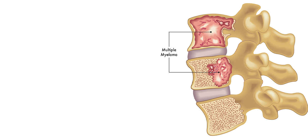 What is Multiple Myeloma? Understanding Symptoms and Treatment Options ...