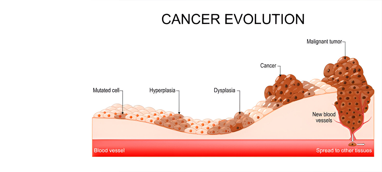 Cancer Stages Explained: A Guide to Diagnosis and Treatment | BMCHRC