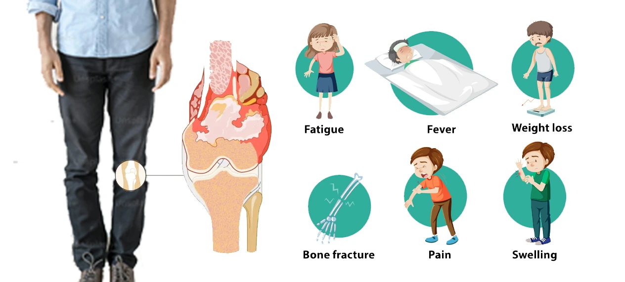 Understanding Pediatric Bone Cancer: Symptoms, Treatment, and Care | BMCHRC