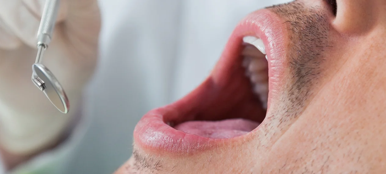 Understanding Oral Cavity Cancer: Symptoms, Causes, and Care