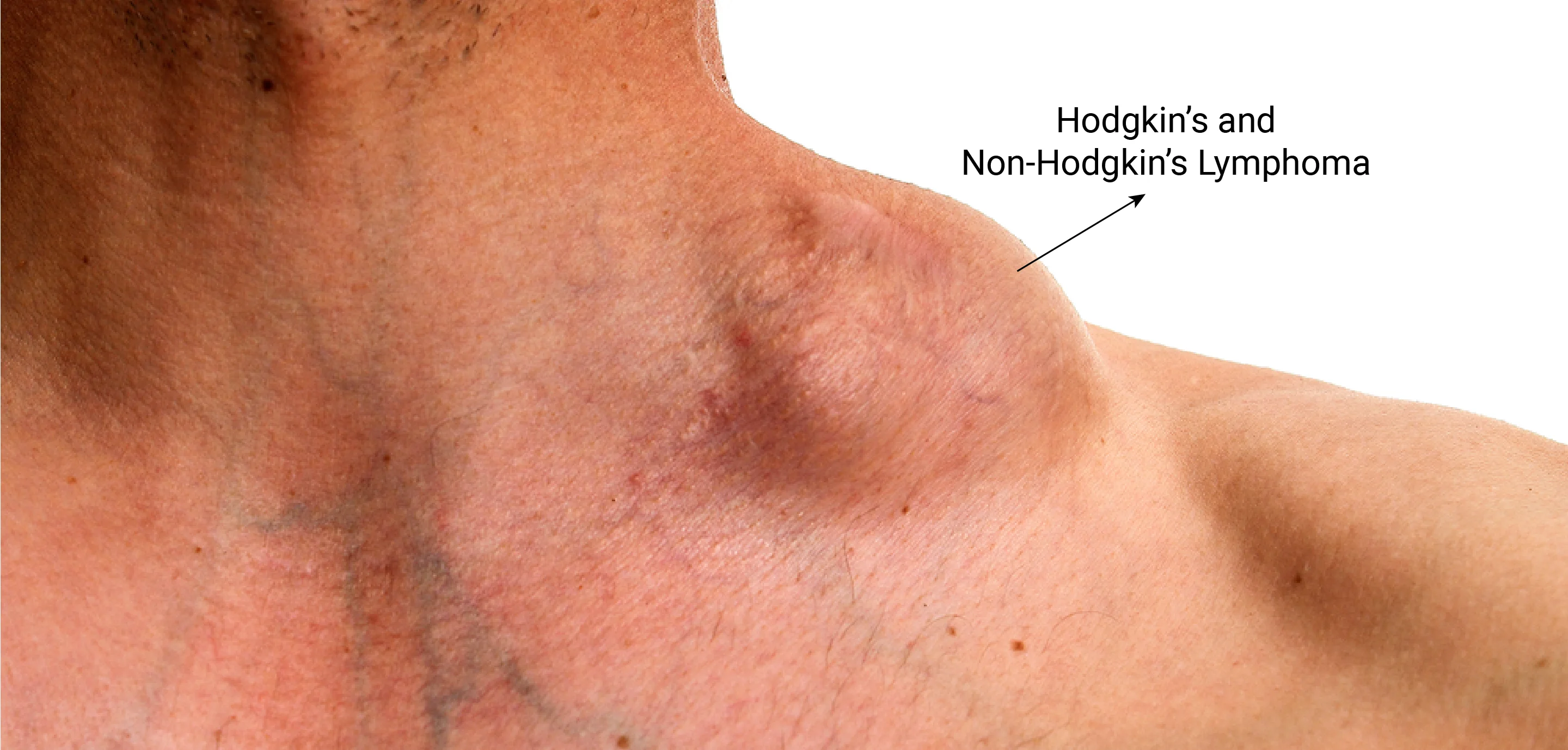 Hodgkin's & Non Hodgkin's Lymphoma Treatment in Jaipur, India