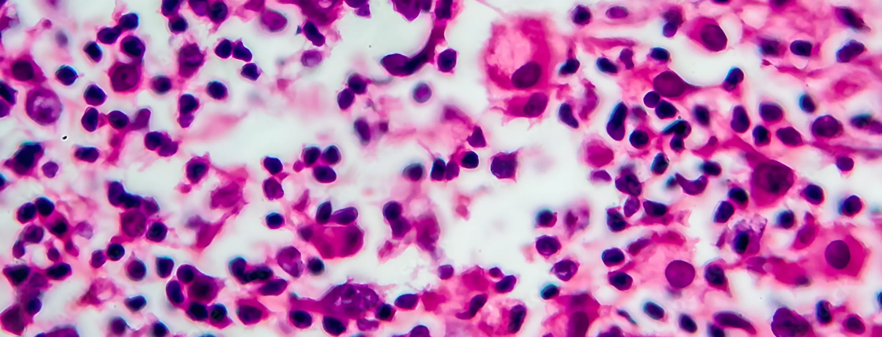 Hodgkin Lymphoma Symptoms | Signs, Diagnosis & Types